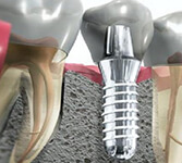 Bio-implants Discoveries in Developing Markets Open New Growth Avenues