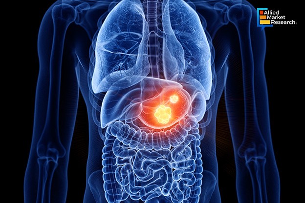 Role of Artificial Intelligence in early gastric cancer diagnosis