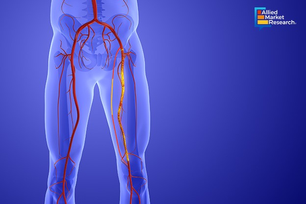 Advances in Peripheral Artery Disease Treatments