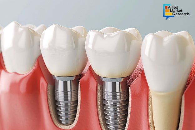 Exploring Recent Developments in the Bioimplants Industry